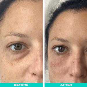 PRF Injections For Under Eye Treatment | St Pete Wellness & Medspa